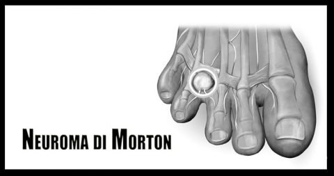 Neuroma di Morton - Medicinafisica.it