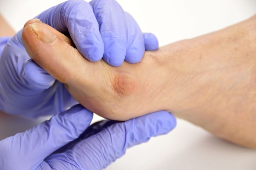 Alluce Valgo - Medicinafisica.it