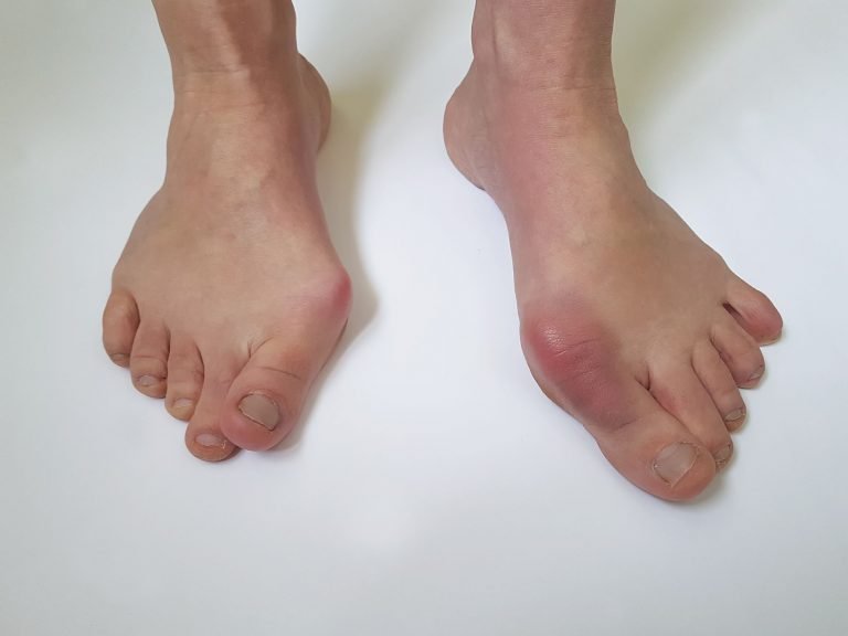 Alluce Valgo - Medicinafisica.it